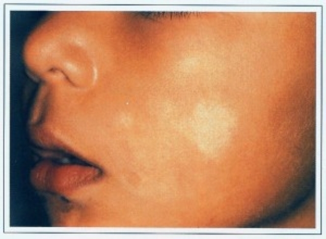 Manchas Brancas Nos Labios Hpv